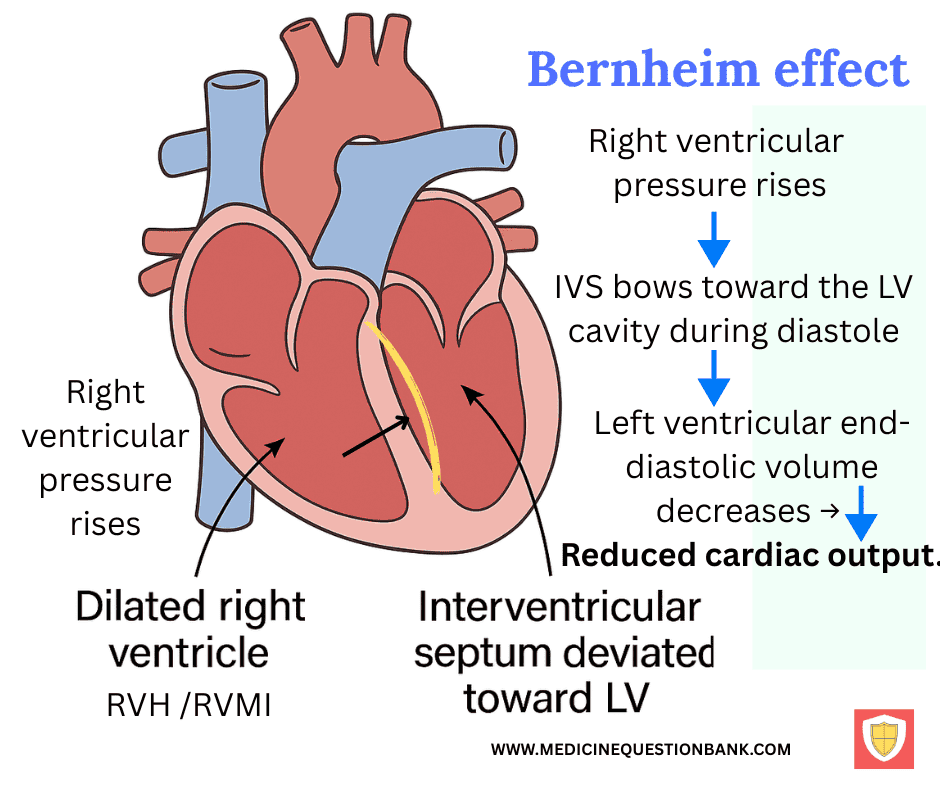 Bernheim effect - Medicine Question Bank
